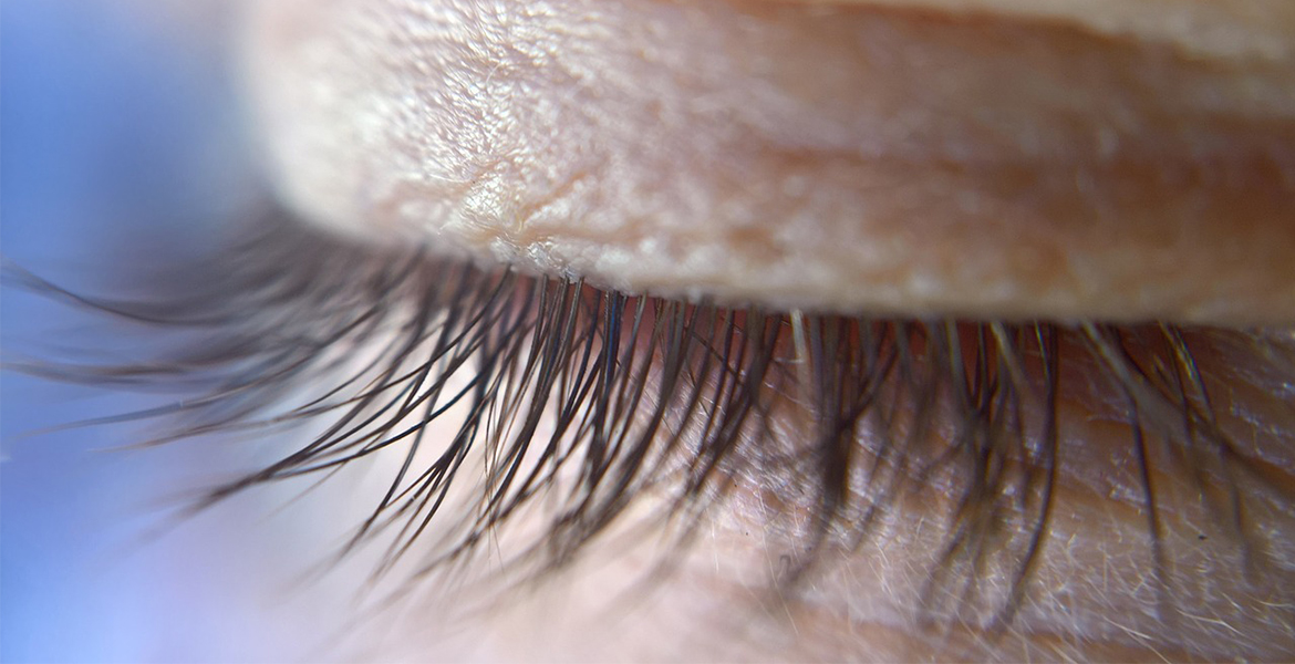 Blefarite agli occhi: cause, sintomi e cure - Lenstore.it